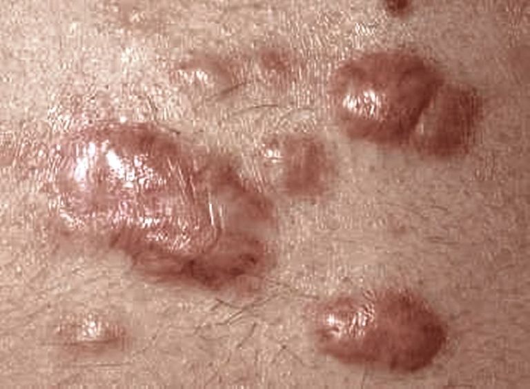 ¿Qué es un queloide? | Diario Crónica