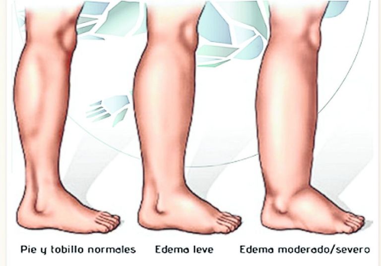 EDEMA | Diario Crónica